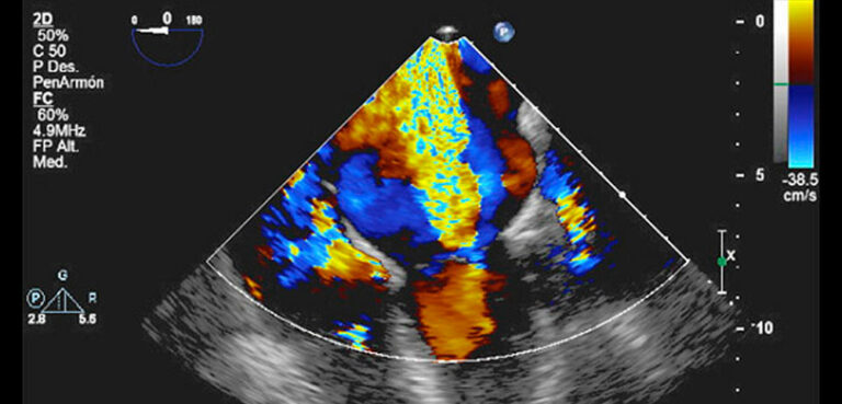 Ecocardiograma 2D ¿Qué es y para qué sirve?